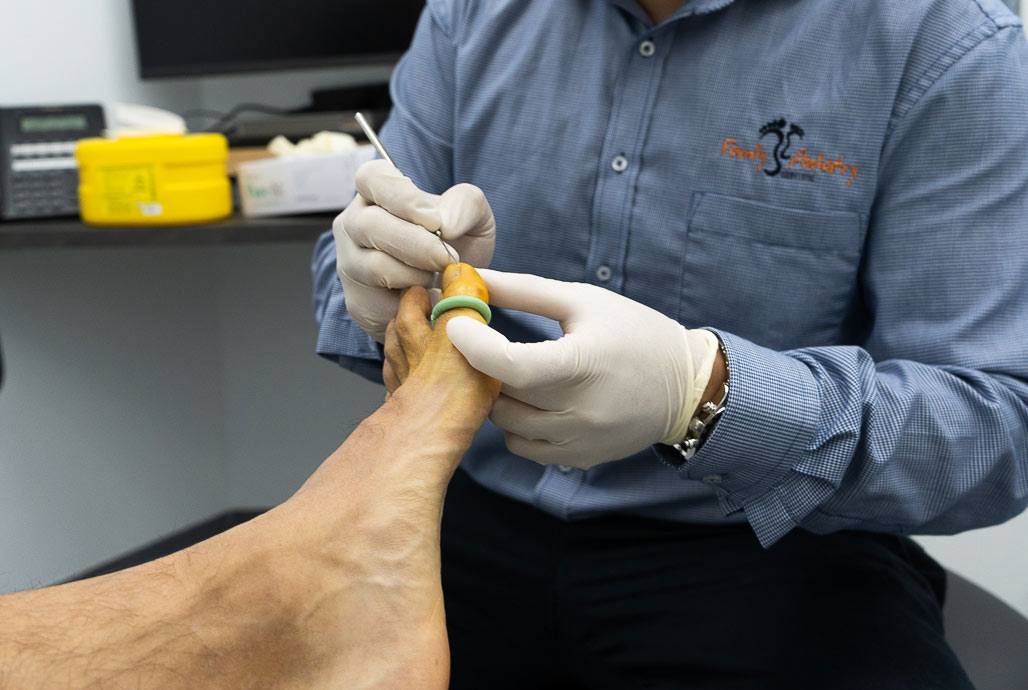 Ingrown Toe-nail Surgery - Family Podiatry Centre